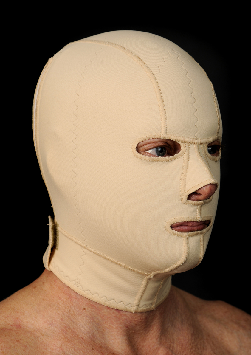 Burns Scarring | Second Skin UK